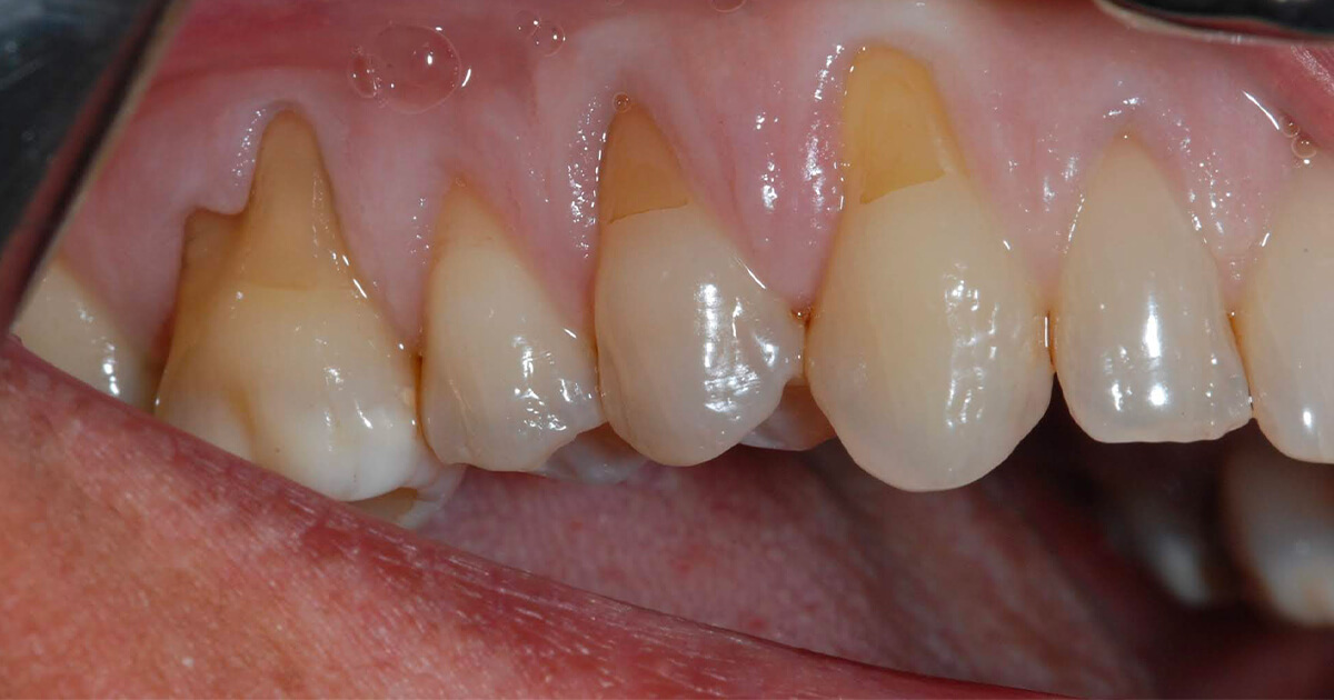 Gengive che si ritirano: perchè e cosa fare - CLINICA VIANA