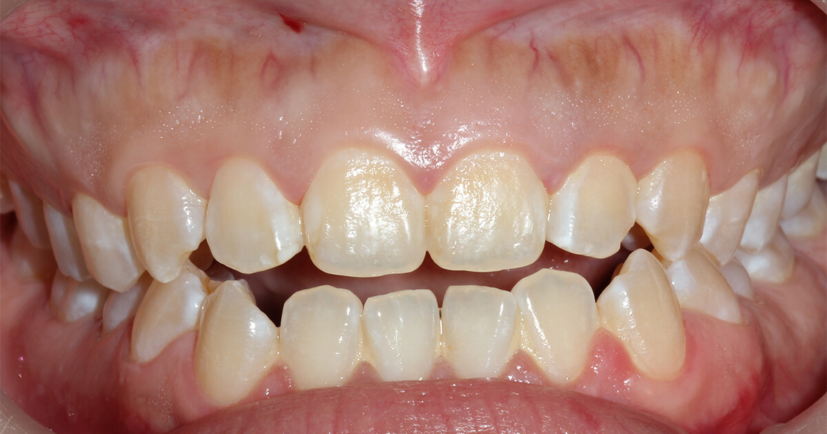 Morso aperto: cos'è e come sconfiggerlo - CLINICA VIANA