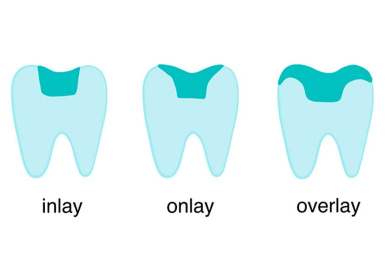 Ricostruzione dente devitalizzato: come funziona - CLINICA VIANA