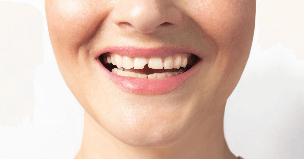 Dente rotto senza dolore: cosa significa - CLINICA VIANA